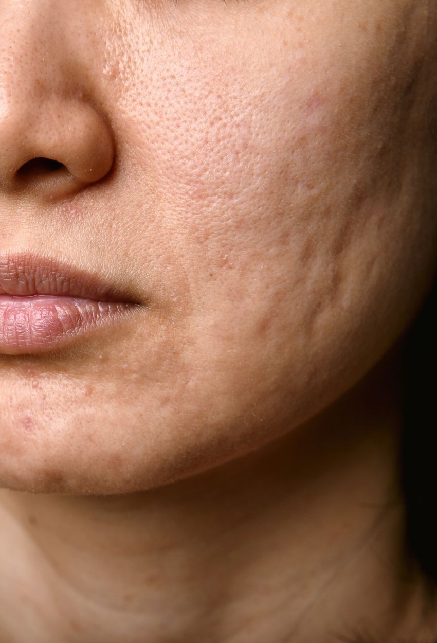 Acne Scars - Gold Skin Care Center | Dermatology Nashville TN | Acne ...